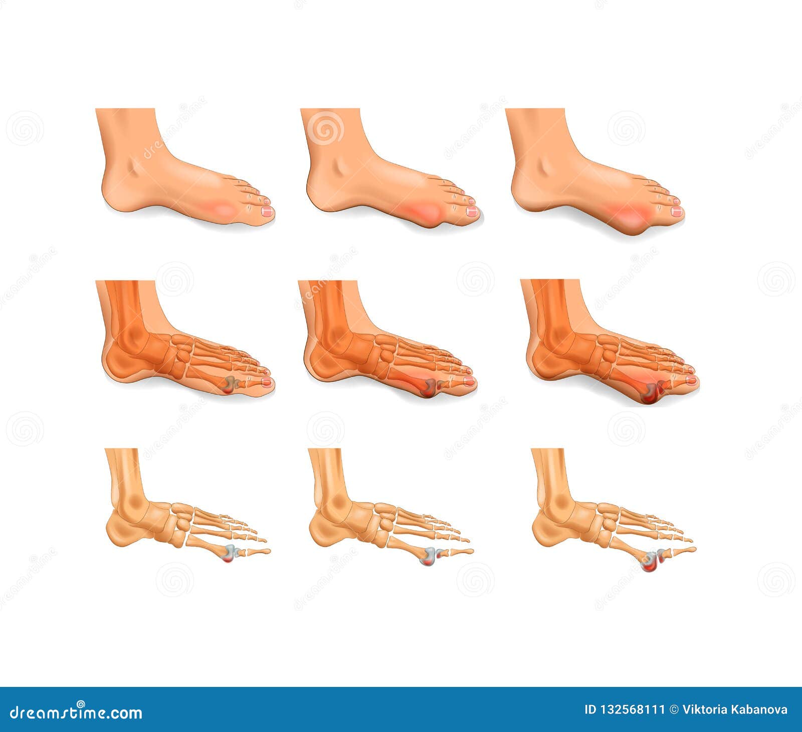 Arthritis, Arthrosis Of The Big Toe Cartoon Vector | CartoonDealer.com ...