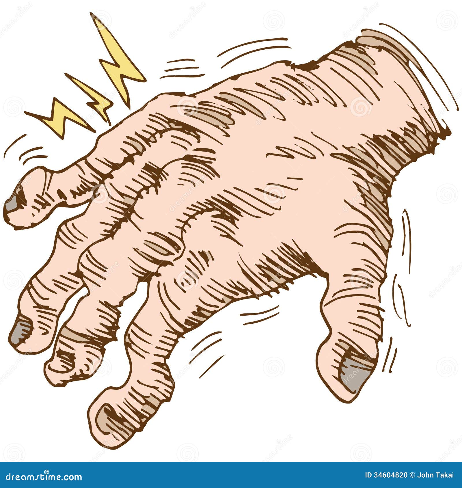 Swollen Hand And Normal Hand. Edema And Lymphedema. Vector Illustration ...