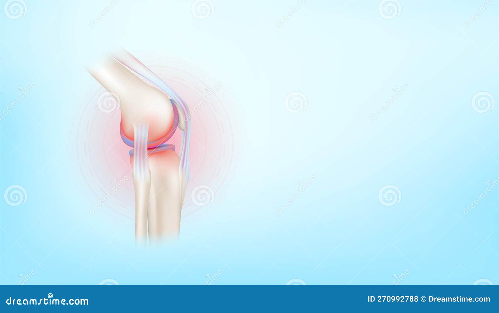 Hip Osteoarthritis Bone Disease With Painful Skeletal Spurs Outline ... Hip Osteoarthritis Bone Disease With Painful Skeletal Spurs Outline ...