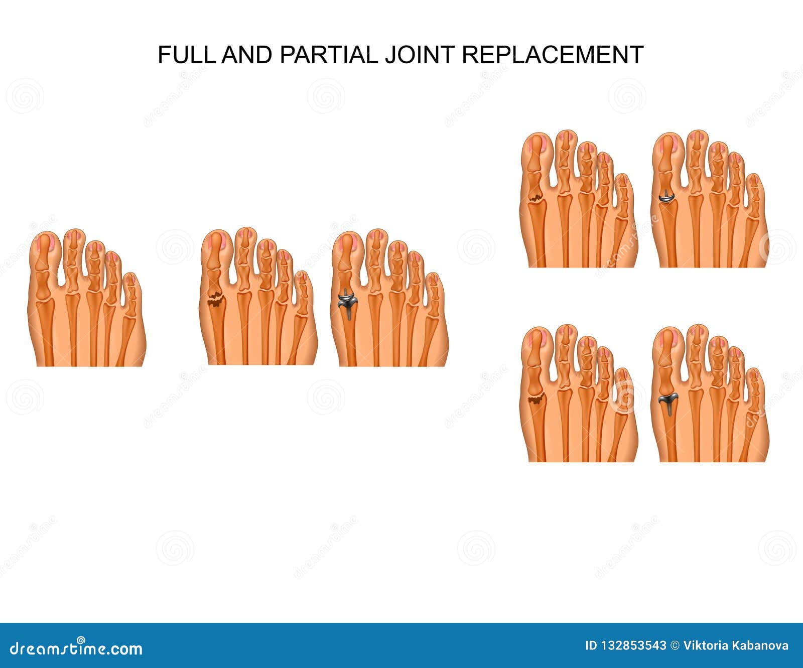 Arthroplasty Of The Big Toe Joint Cartoon Vector | CartoonDealer.com ...