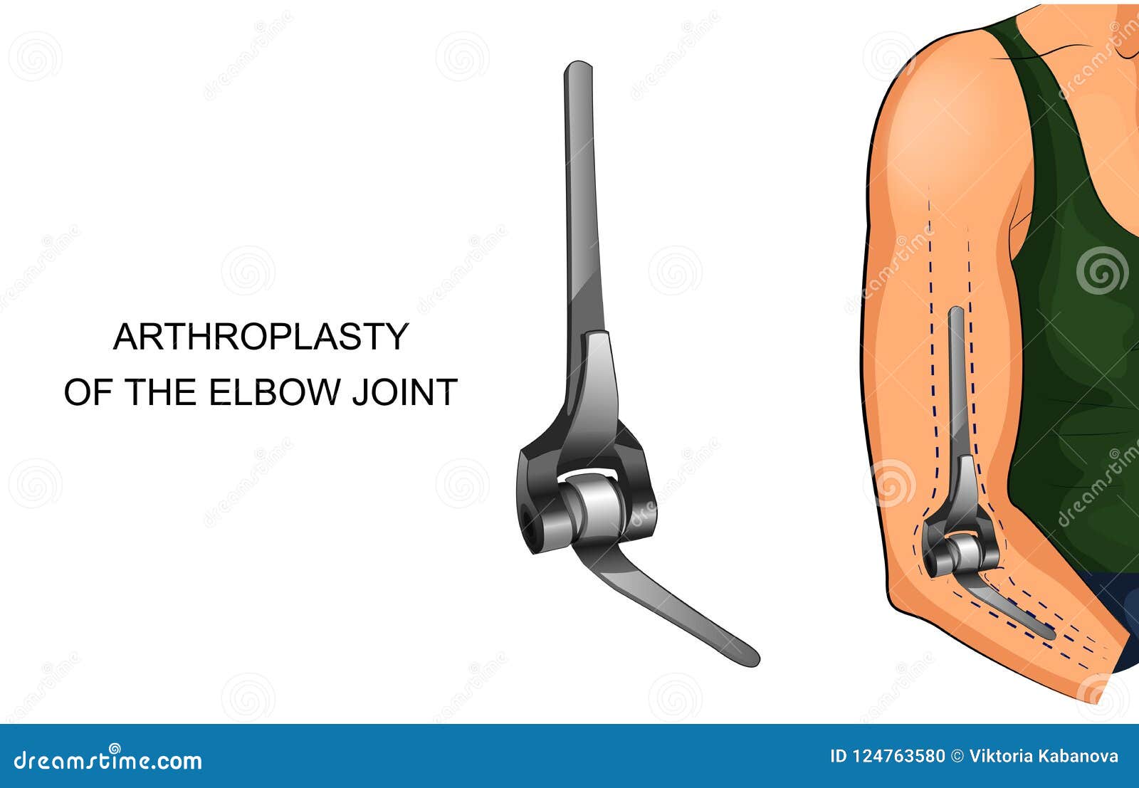 Elbow Ligaments With Medical Medial Or Lateral Xray Structure Outline ...