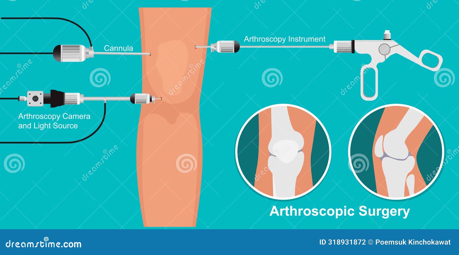 Arthroscopy Medical Treatment Surgery Stock Vector Illustration Of