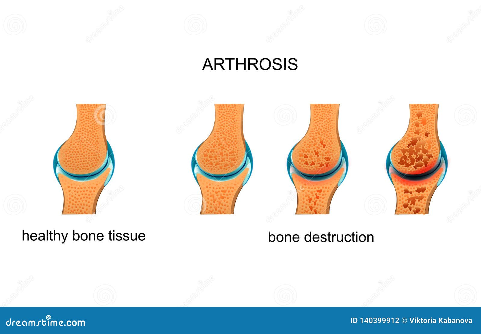 Arthrosis. Bone Destruction Stock Vector - Illustration of joint ...