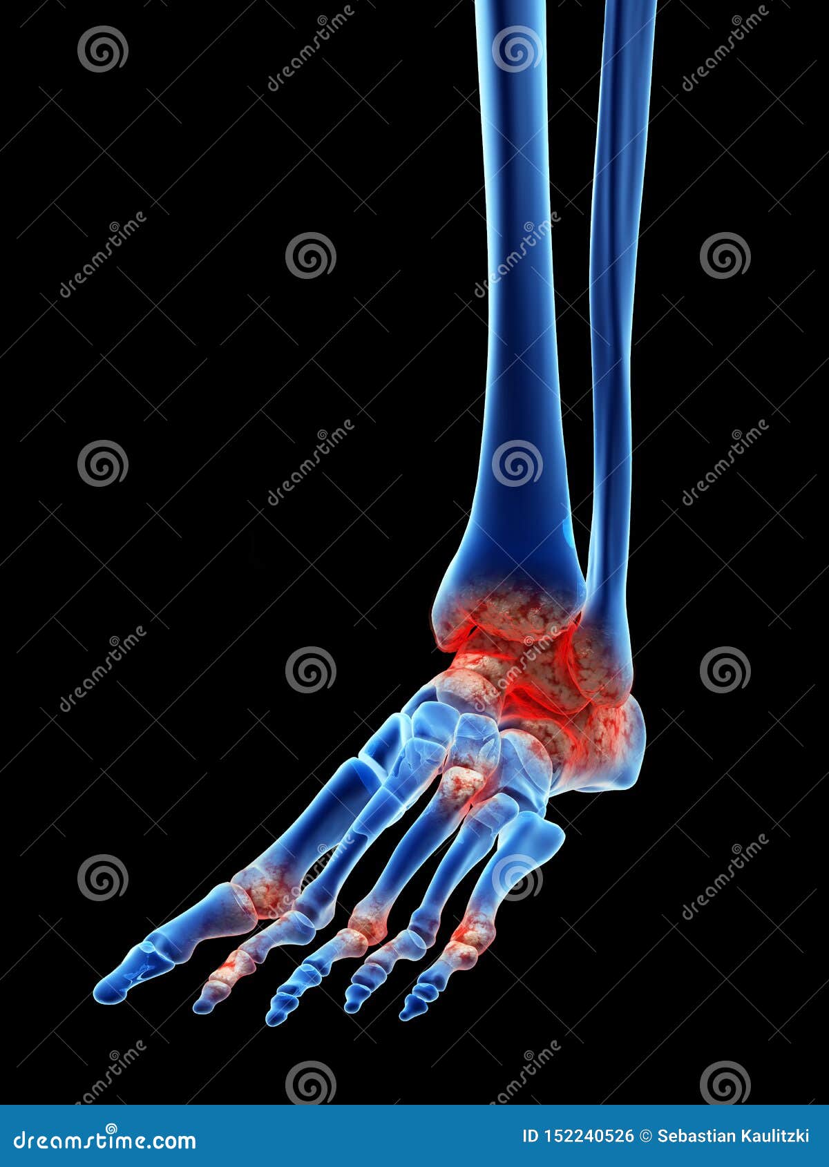 Arthrosis In The Foot Royalty-Free Illustration | CartoonDealer.com ...