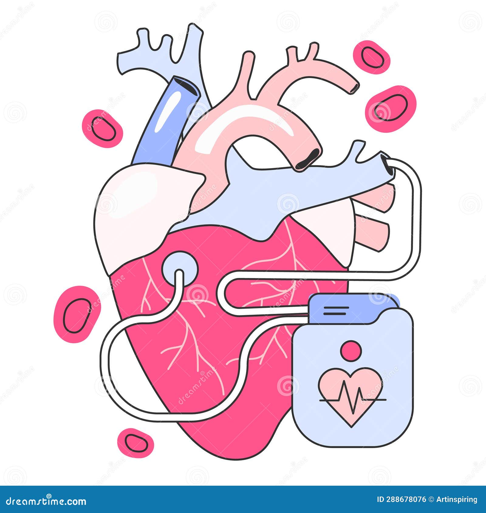 Artificial Cardiac Pacemaker. Medical Device that Generates Electrical ...