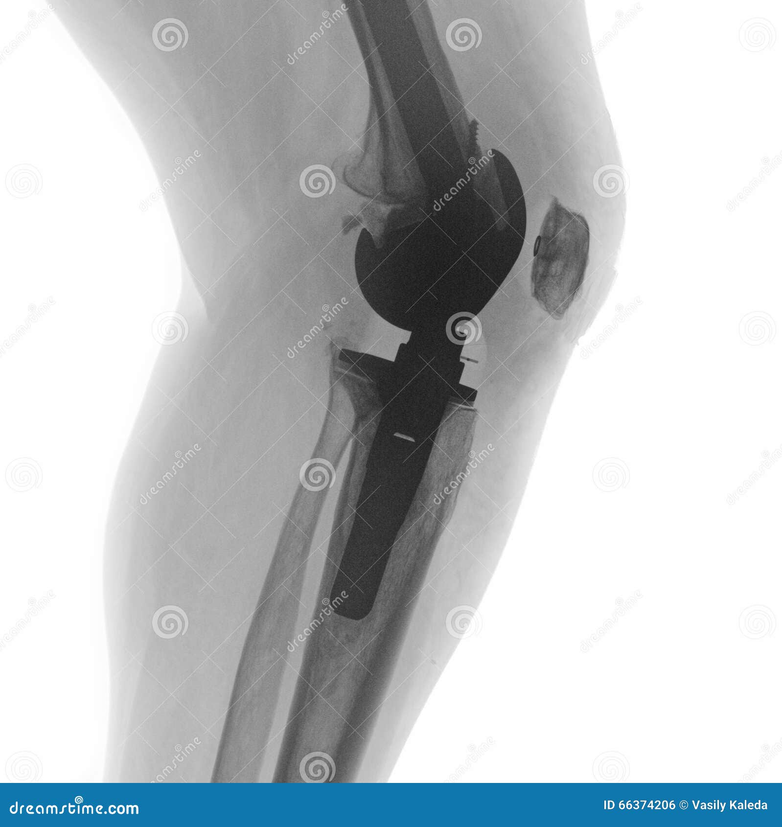 Artificial knee joint stock photo. Image of hinge, knee - 66374206
