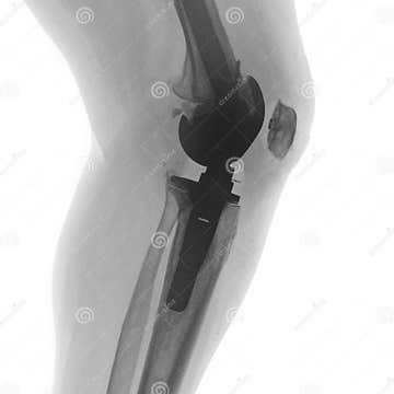 Artificial knee joint stock photo. Image of hinge, knee - 66374206