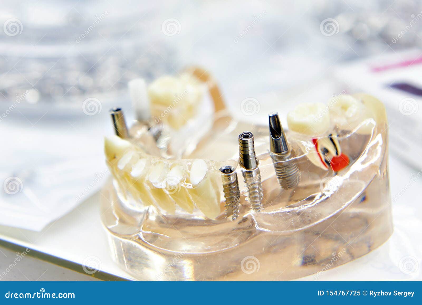 Artificial Plastic Jaw with Dental Implants Stock Image - Image of ...