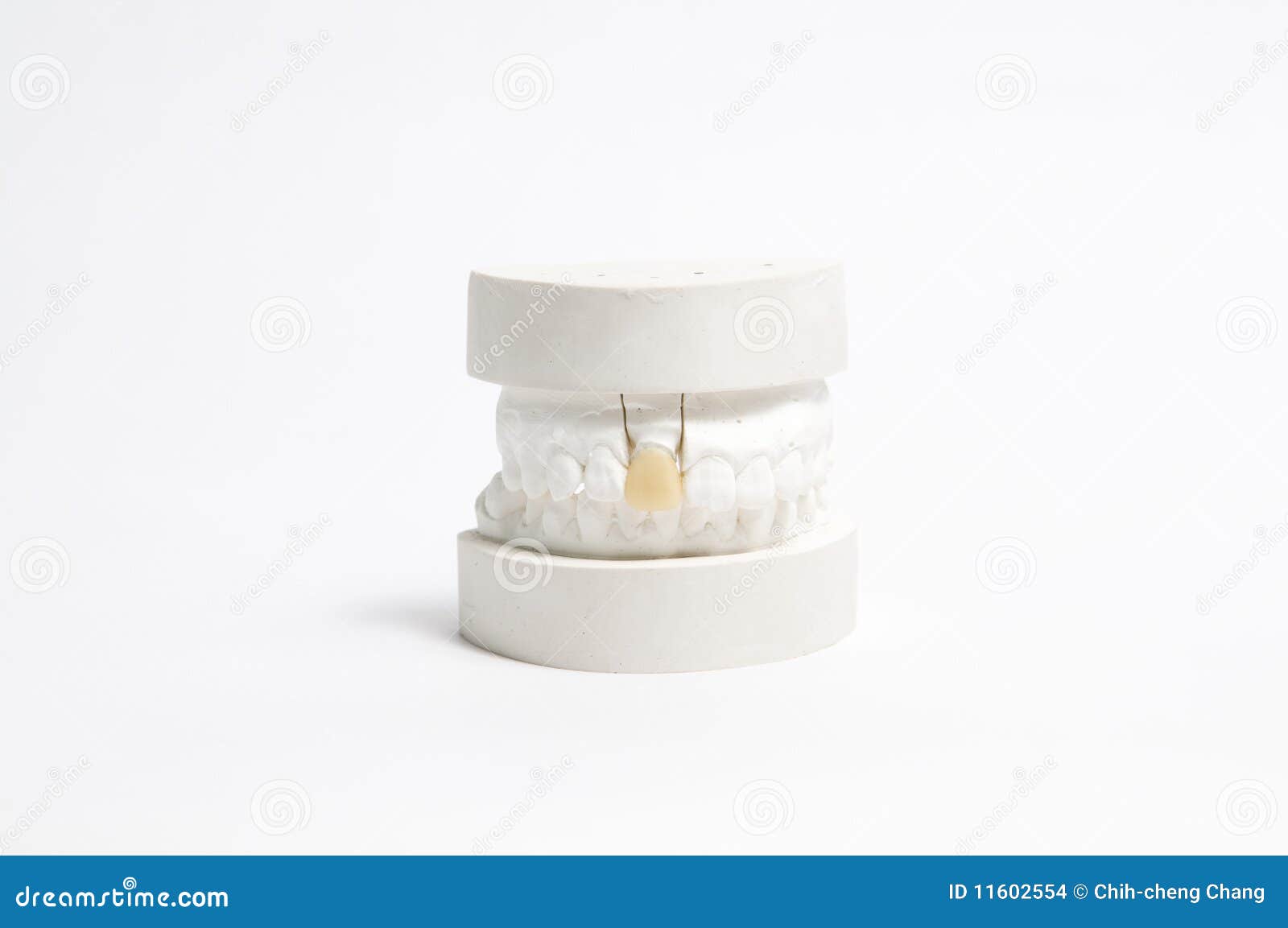 Artificial Tooth, Dental Prosthesis With False Silver Tooth, Metalic ...