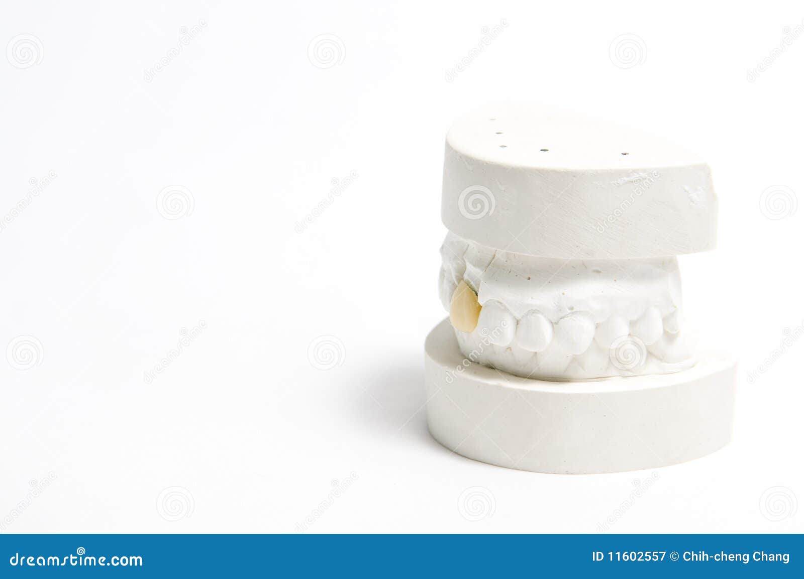 Artificial Tooth, Dental Prosthesis With False Silver Tooth, Metalic ...