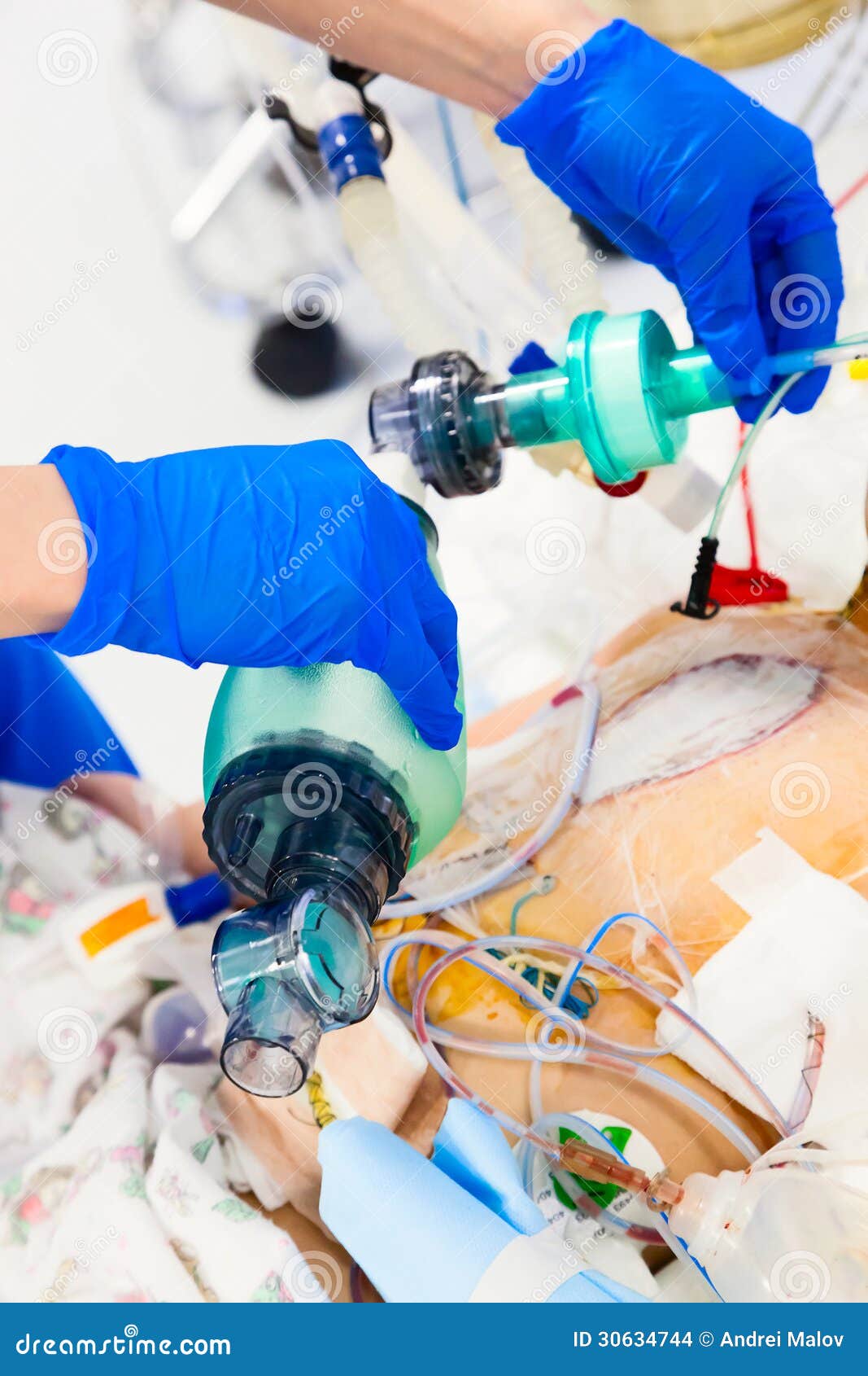 Artificial Ventilation with Bag-valve-mask Stock Photo - Image of ...