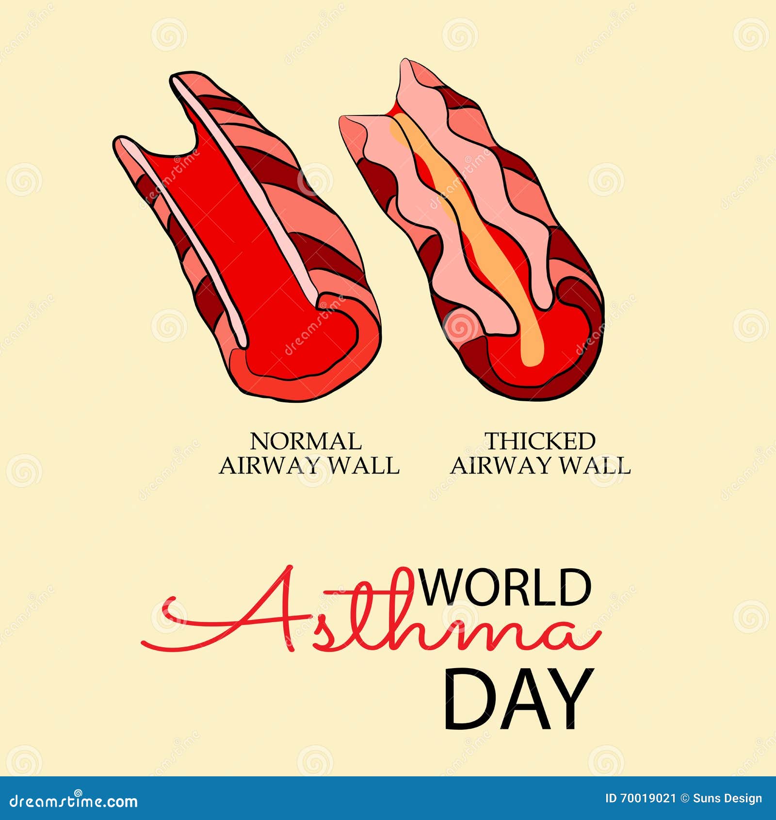 Ashtma day stock illustration. Illustration of bronchospasm - 70019021