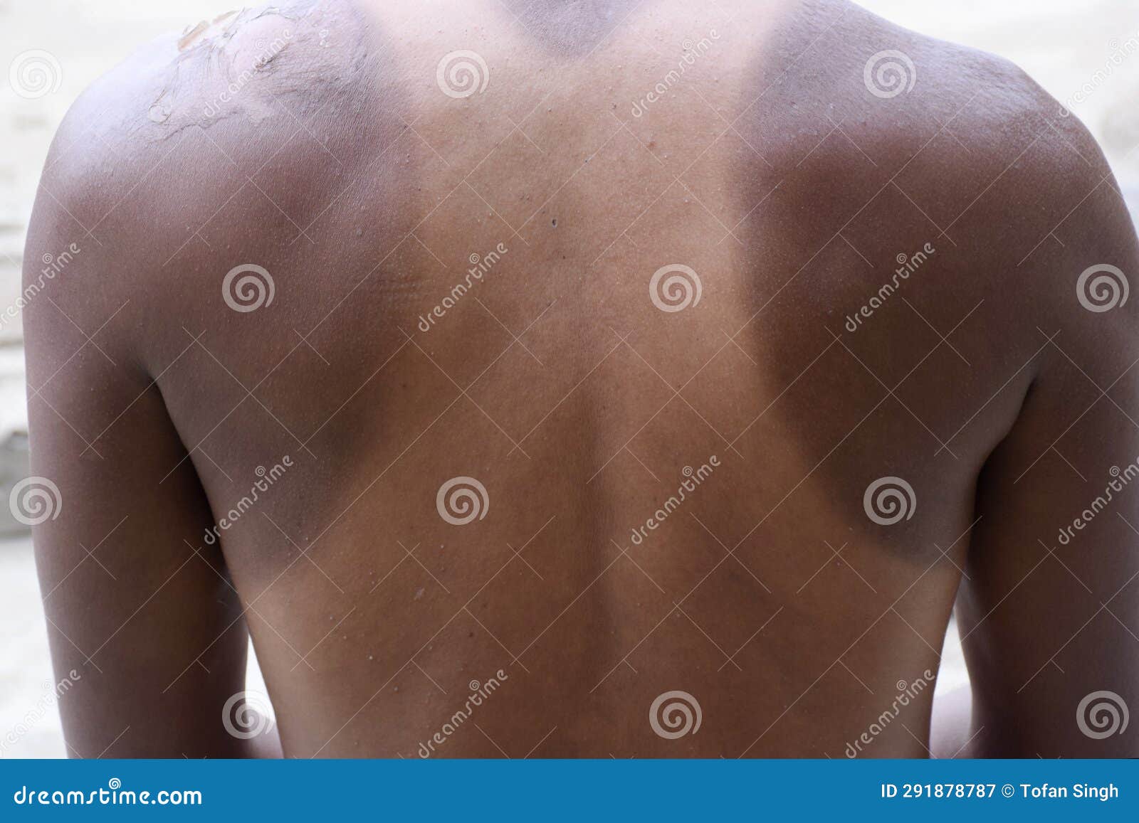 Asian Man Back with Red Skin Sunburn after Work in the Fields Stock ...