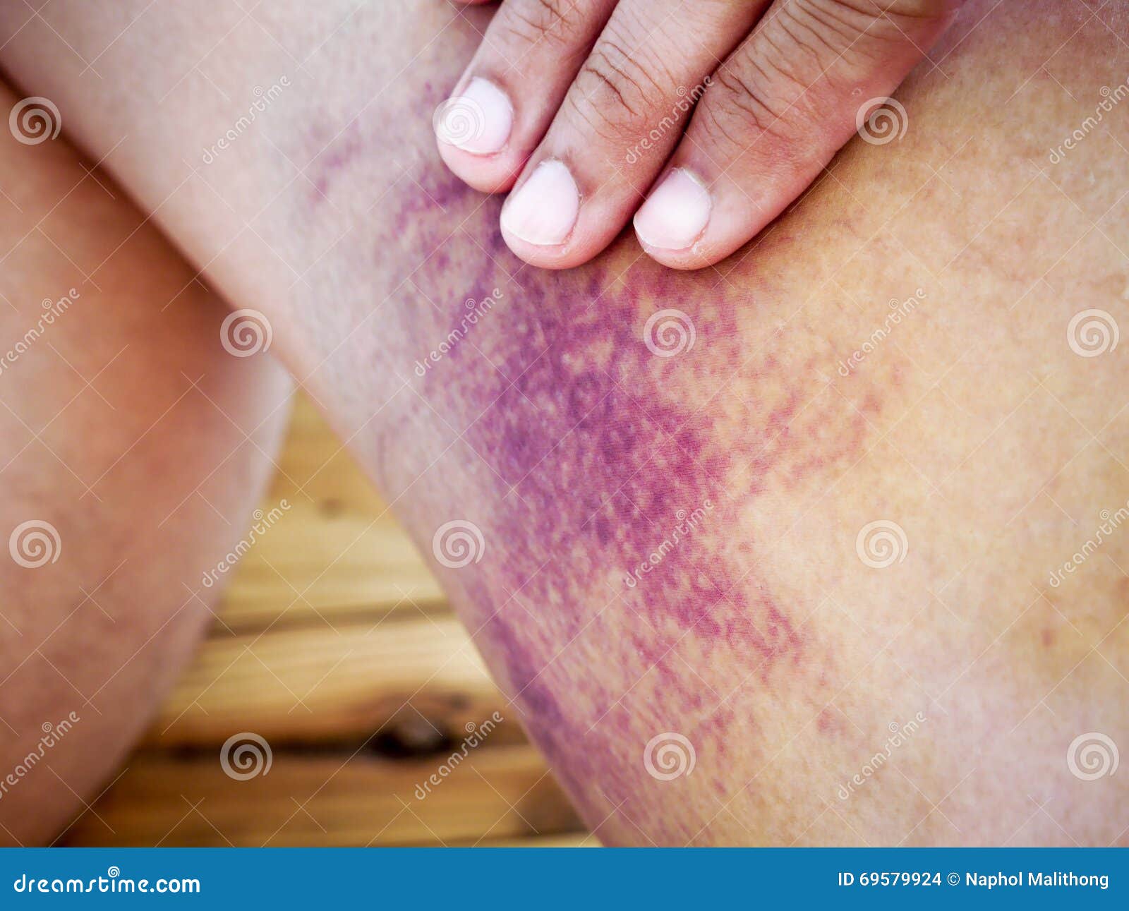 Swollen And Bruised Toes With Out Of Focus Background Stock Image ...