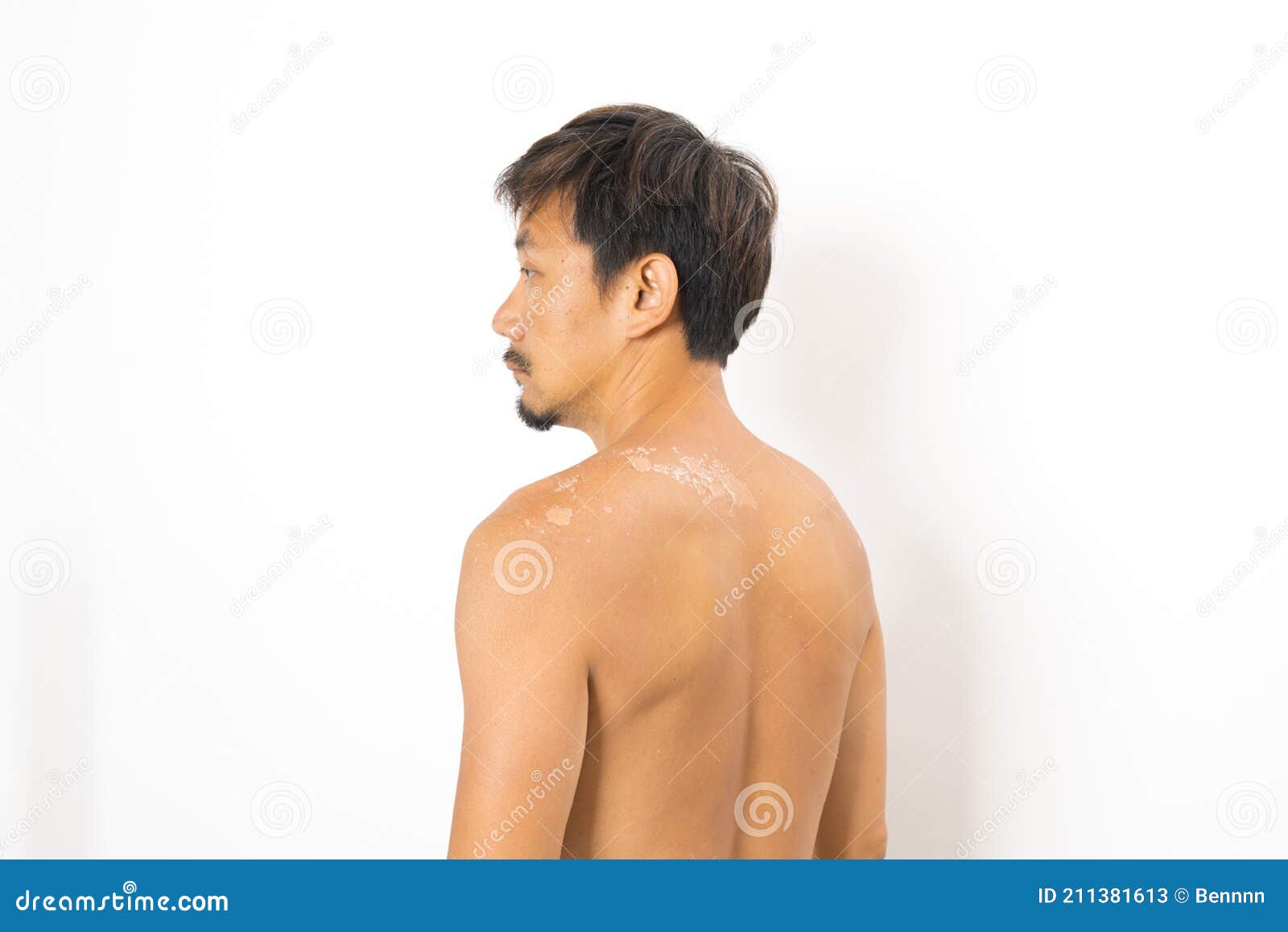 Asian Man With Sunburned Skin And Face Stock Image Image Of Person