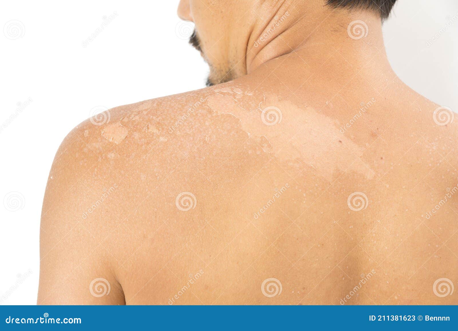 Asian Man With Sunburned Skin And Face Stock Image Image Of Adult