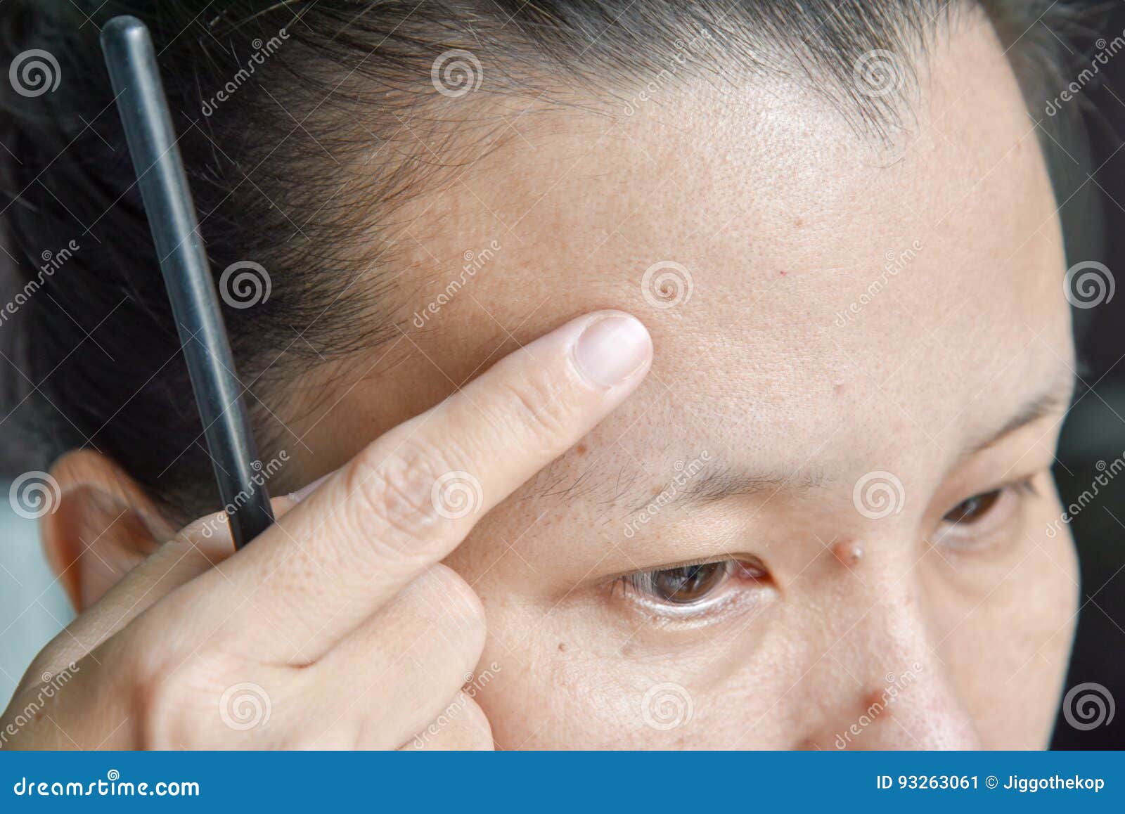 Mole Removed Via Skin Graft Procedure Leaving Scar Royalty Free Stock