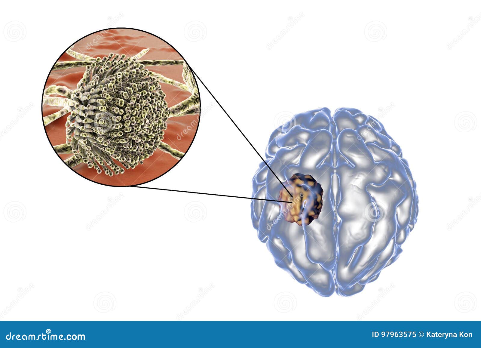 Aspergilloma Of The Brain And Close Up View Of Fungi Aspergillus Stock Illustration