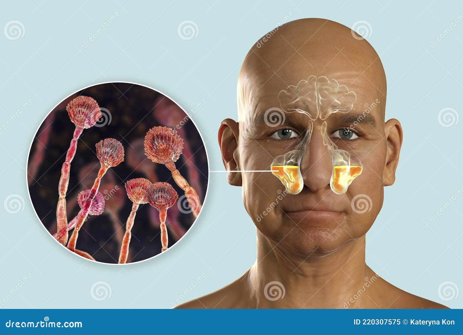 Aspergillus Fungi As A Cause Of Sinusitis Stock Illustration Illustration Of Treatment