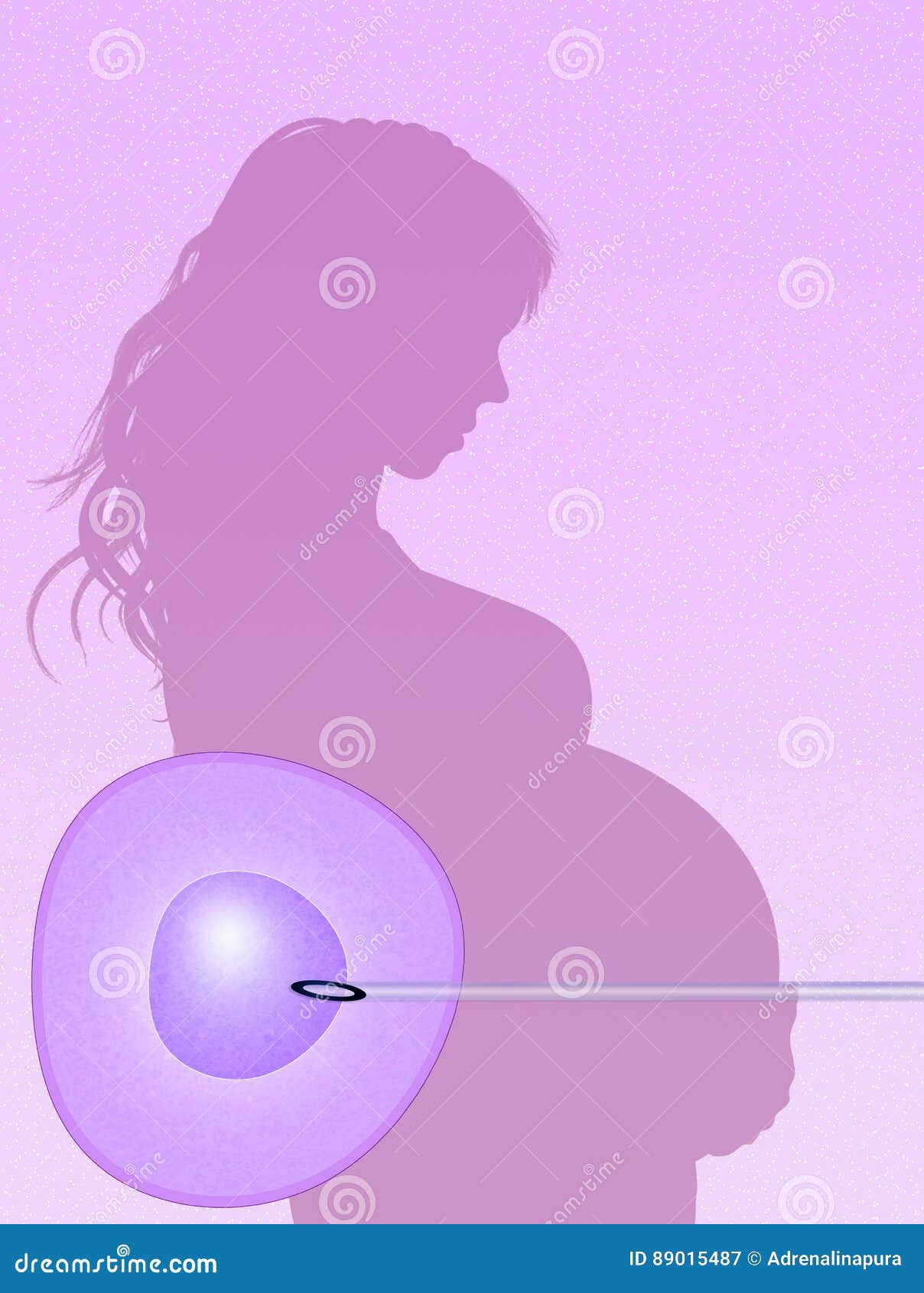Assisted reproduction stock illustration. Illustration of sperm - 89015487