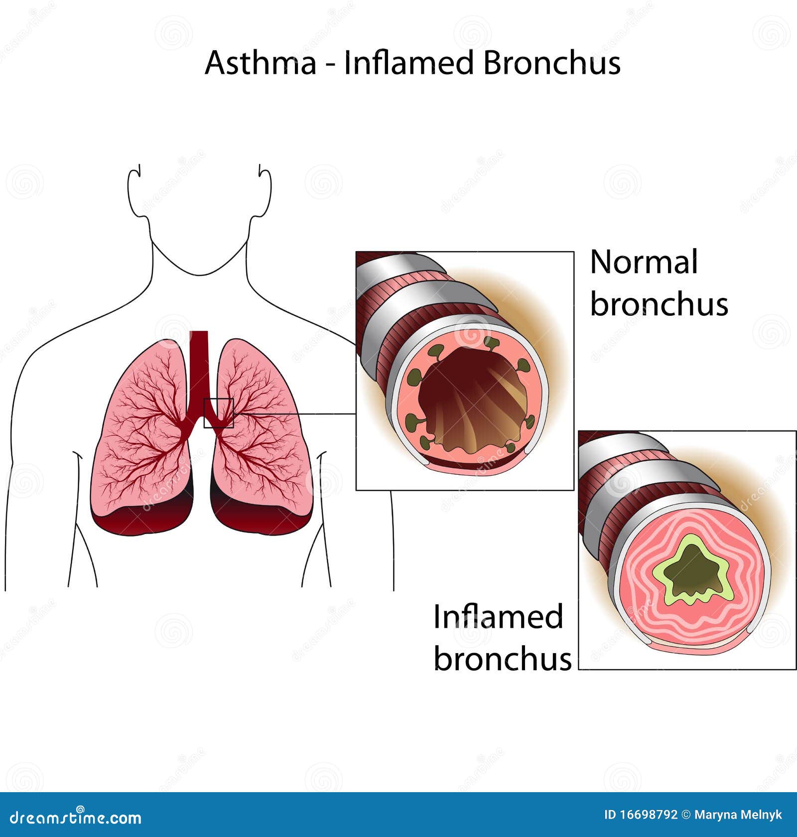 Asthma stock vector. Illustration of computer, bronchial - 16698792