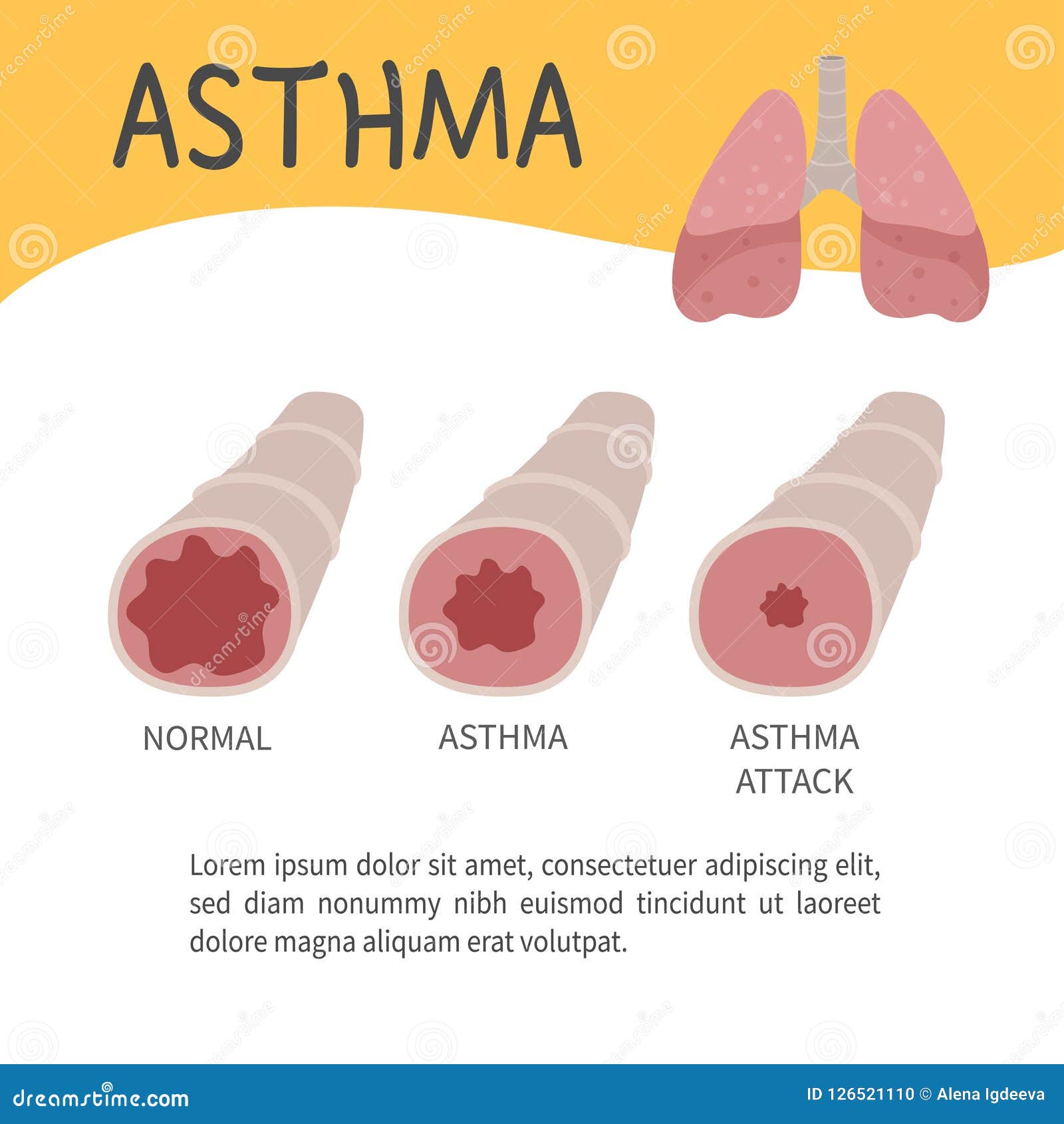 Asthma Infographic Elements Set Cartoon Vector | CartoonDealer.com ... Asthma Infographic Elements Set Cartoon Vector | CartoonDealer.com ...