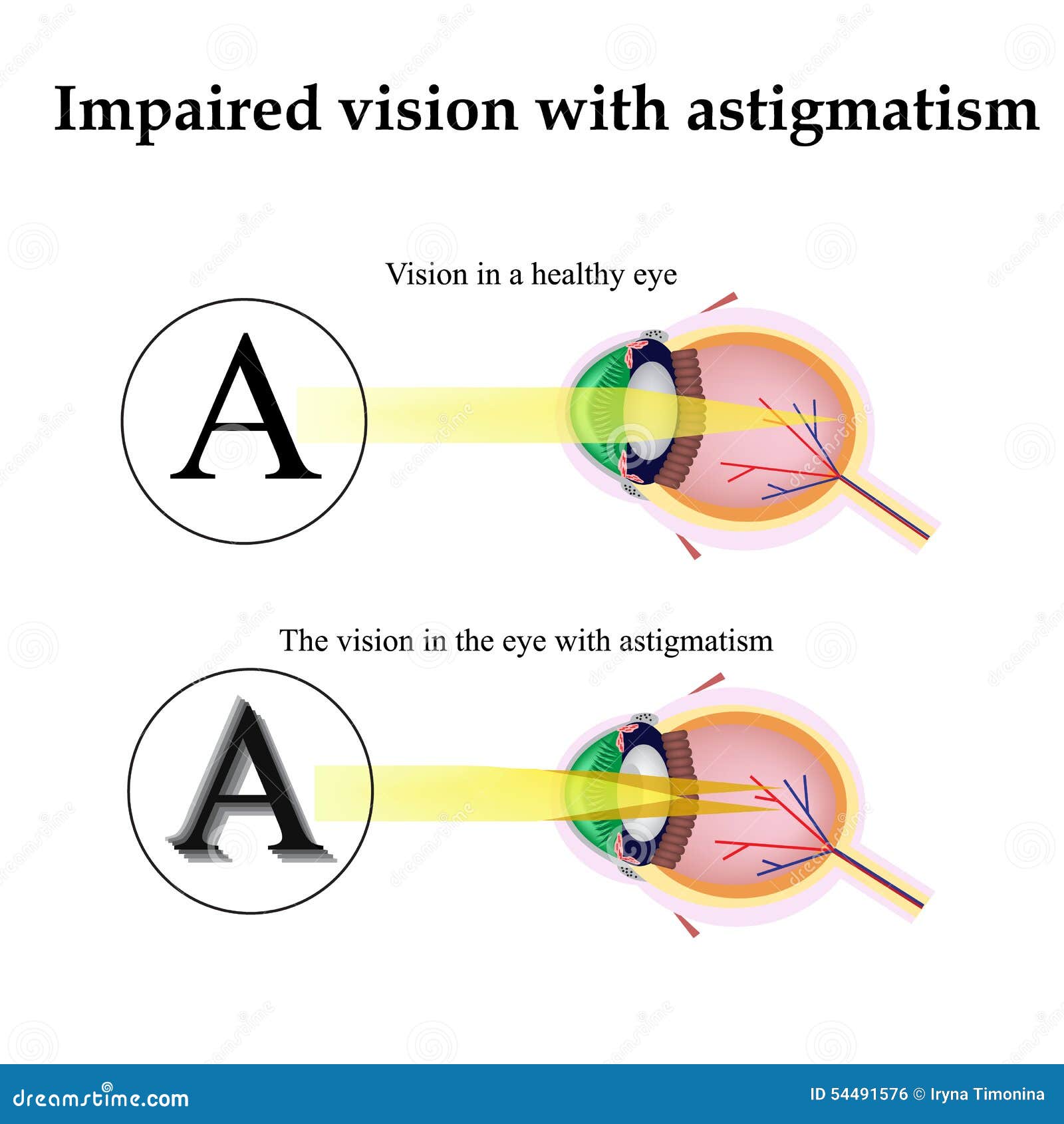 Impaired Vision With Astigmatism. As Astigmatism Cartoon Vector ...