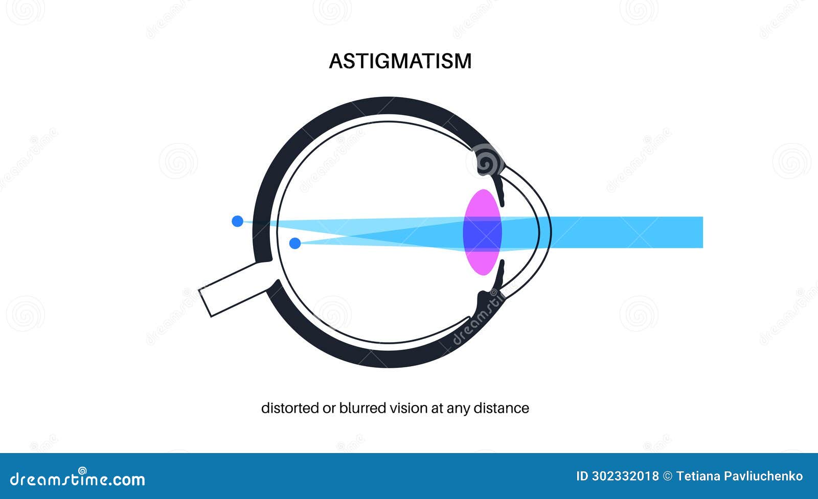 Astigmatism eye disease stock illustration. Illustration of sclera ...