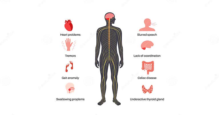 Ataxia Cerebellar Disorder Stock Vector Illustration Of Movement 318265533