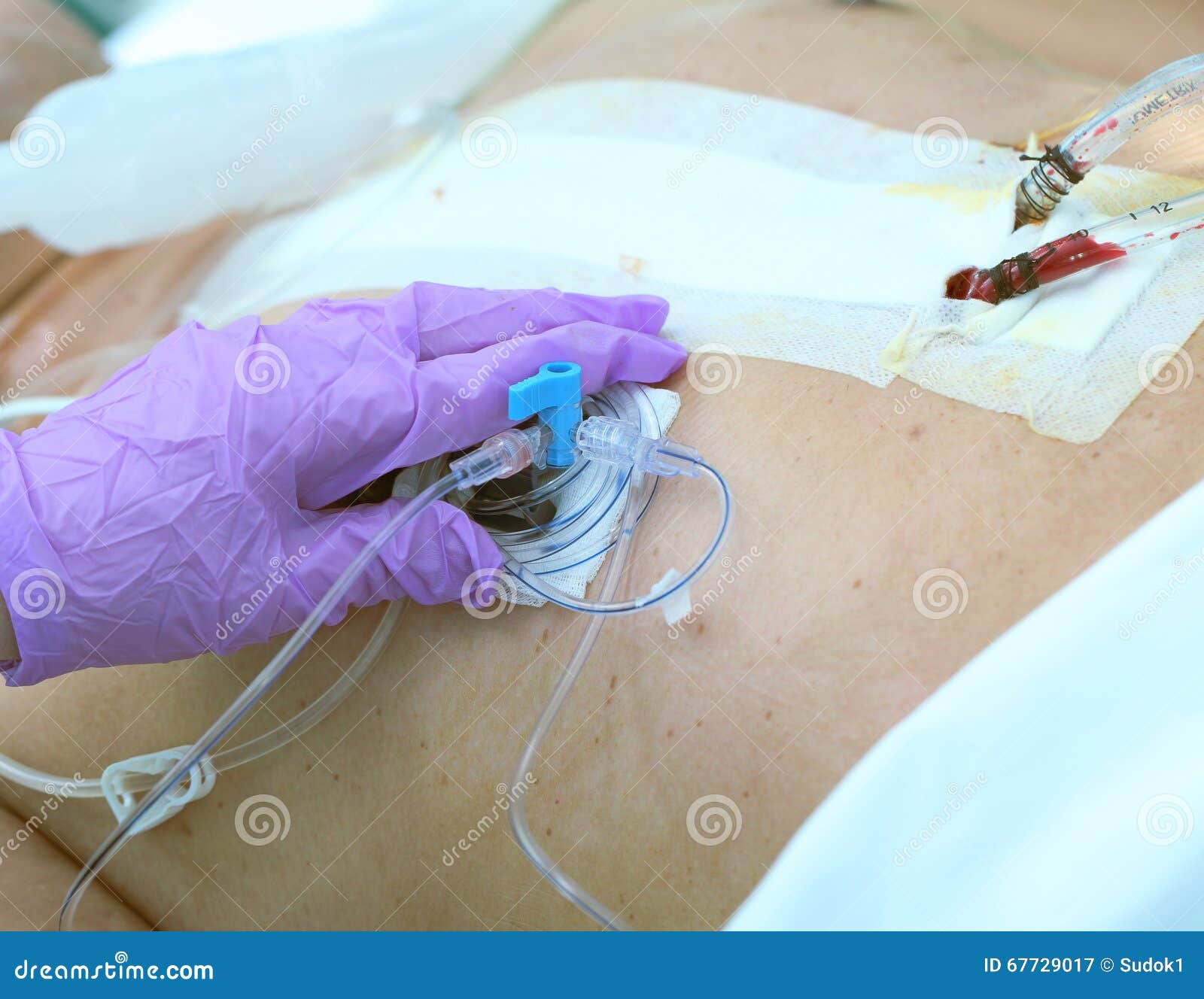 Atención a Los Pacientes En El Período Postoperatorio Temprano Imagen ...