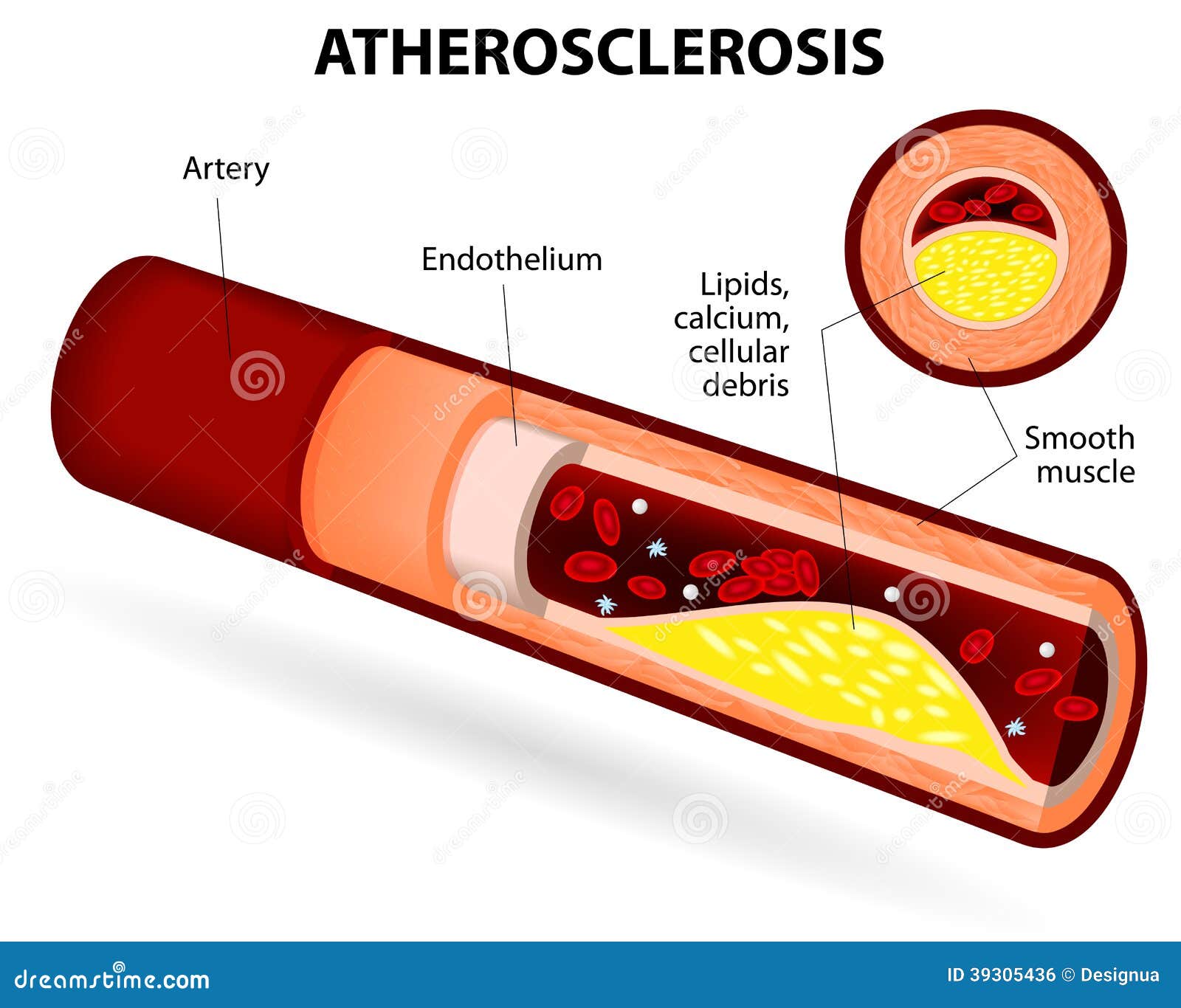 Athérosclérose illustration de vecteur. Illustration du ...