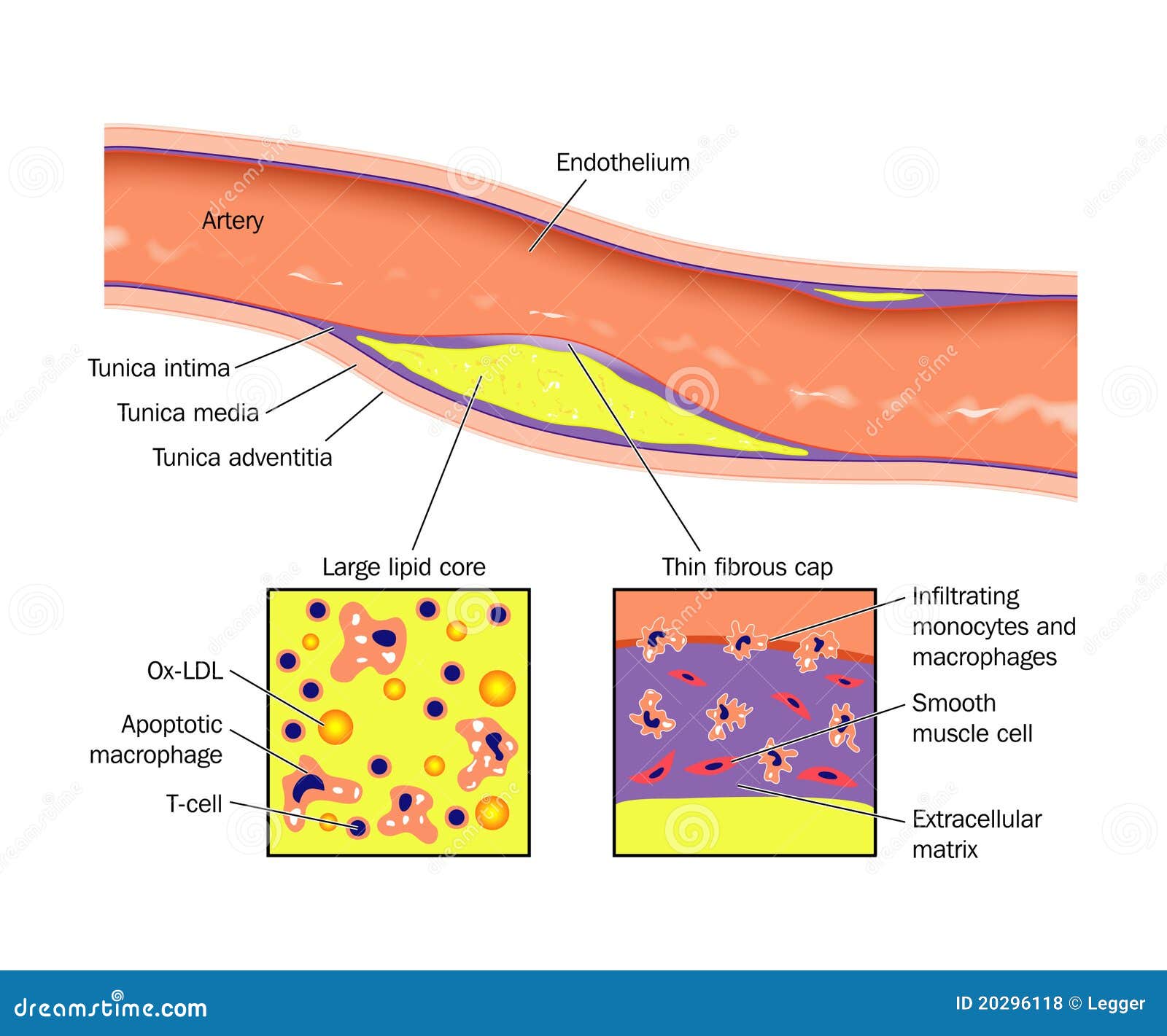Atheromaplaque Van De Slagader Vector Illustratie - Illustration of ...