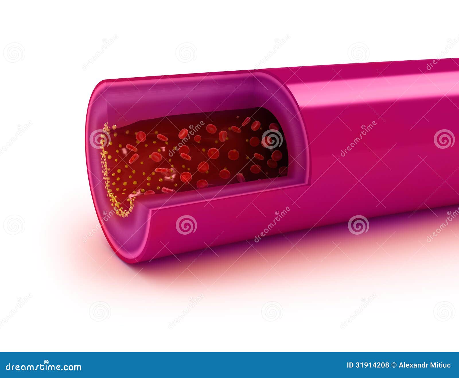 Atherosclerosis in Artery Caused by Cholesterol Plaque Stock ...