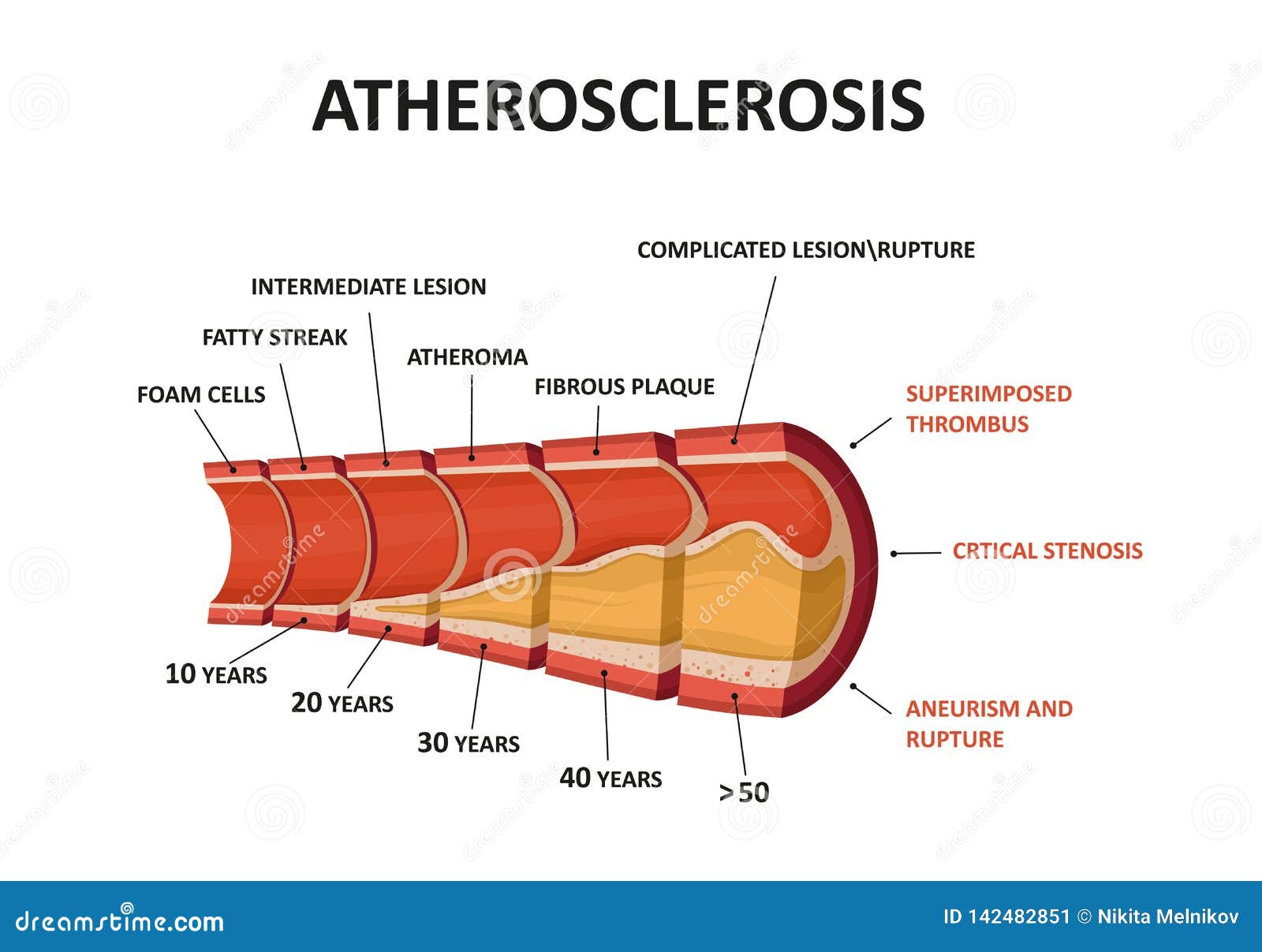 Anatomy Of Atherosclerosis In Artery Stock Photo | CartoonDealer.com ...