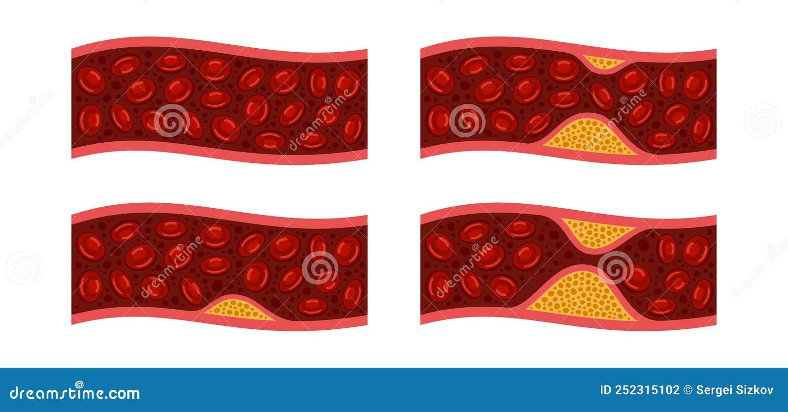 Atherosclerosis. Cholesterol Level. Cross Section Of A Artery With Red ...