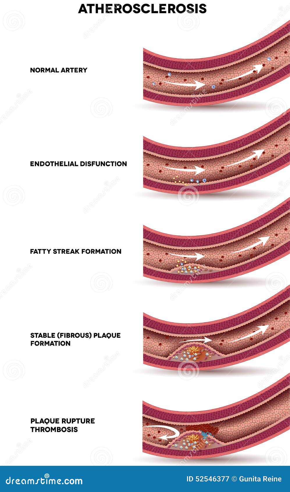 Stages Of Atherosclerosis Cartoon Vector | CartoonDealer.com #86262433 Stages Of Atherosclerosis Cartoon Vector | CartoonDealer.com #86262433