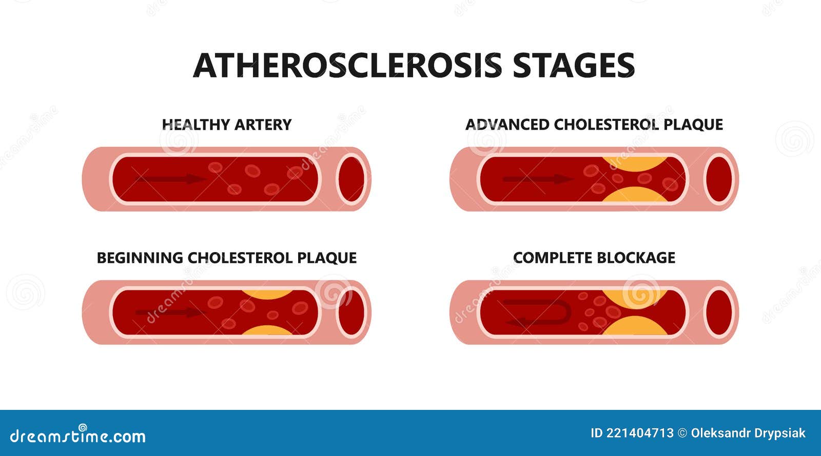 Atherosclerosis Stages. Cholesterol Plaques. Cartoon Vector ... Atherosclerosis Stages. Cholesterol Plaques. Cartoon Vector ...
