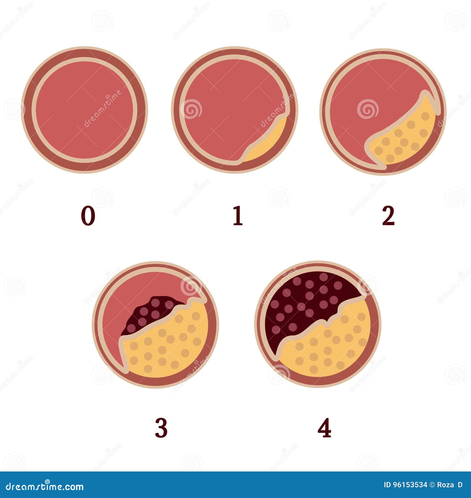 Atherosclerosis stages 1 stock vector. Illustration of clot - 96153534 Atherosclerosis stages 1 stock vector. Illustration of clot - 96153534