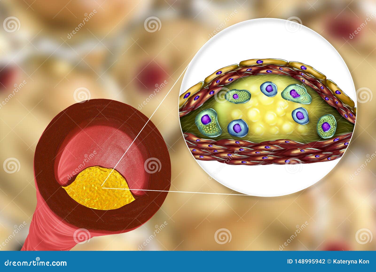 Atherosclerotic Plaque in Human Artery Stock Illustration ...