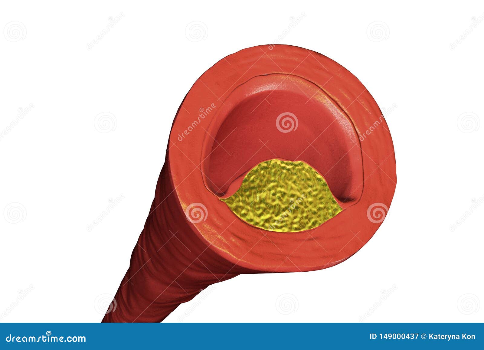 Atherosclerotic Plaque in Human Artery Stock Illustration ...
