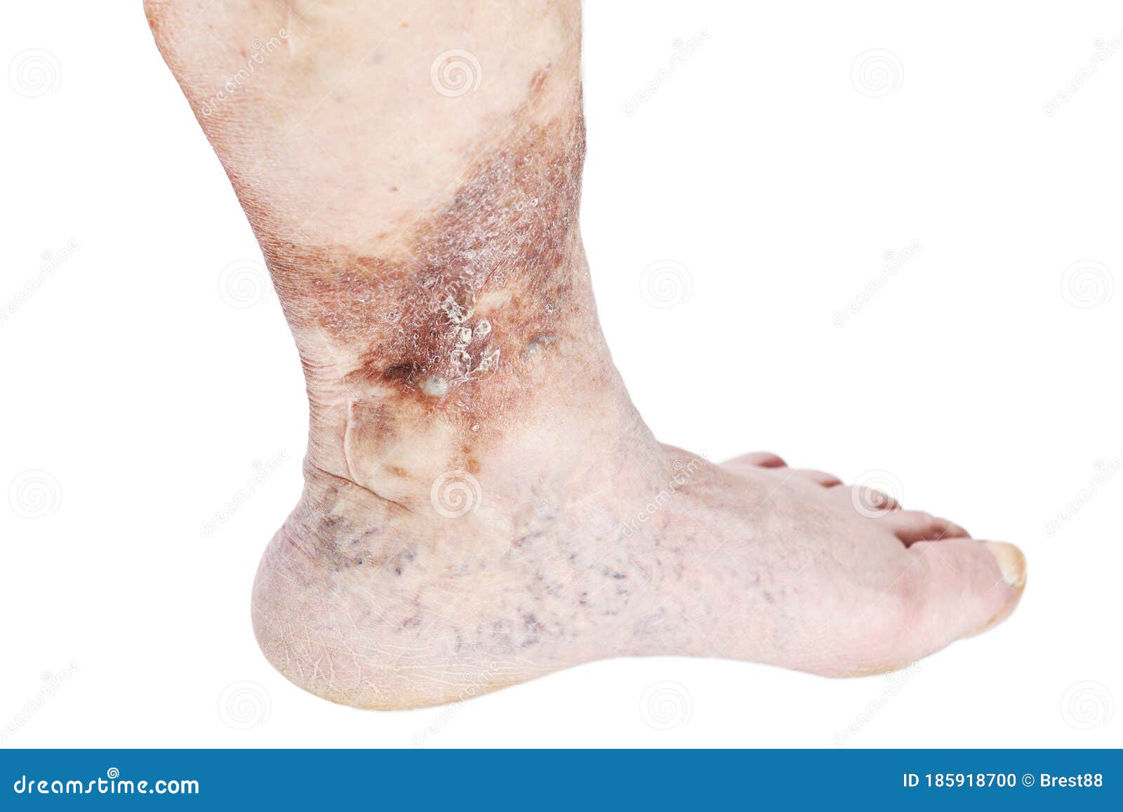 Atopic Dermatitis Ad Also Known As Atopic Eczema Is A Type Of Inflammation Of The Skin