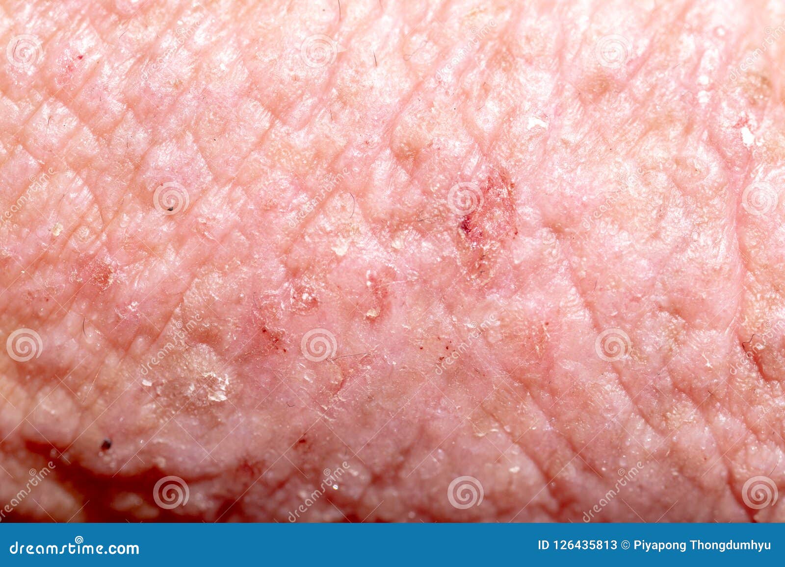 Atopic Dermatitis Ad Also Known As Atopic Eczema Is A Type Of