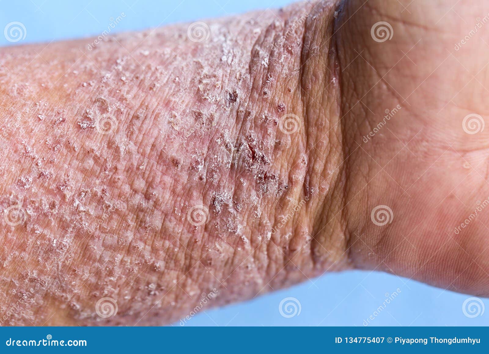 Atopic Dermatitis Ad Also Known As Atopic Eczema Is A Type Of