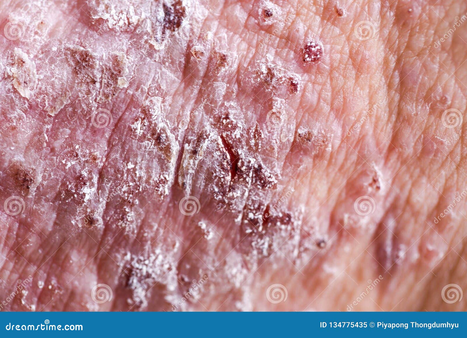 Atopic Dermatitis Ad Also Known As Atopic Eczema Is A Type Of