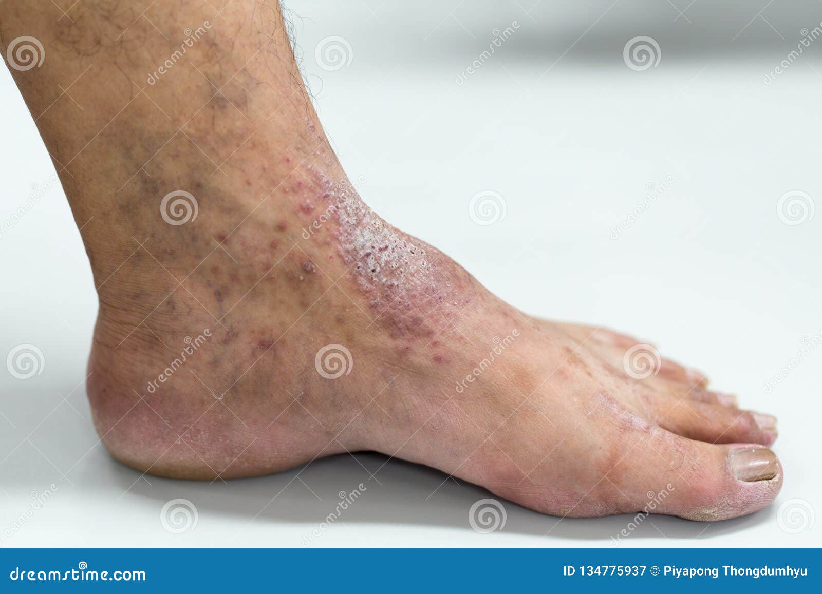 Atopic Dermatitis AD, Also Known As Atopic Eczema, is a Type of ...