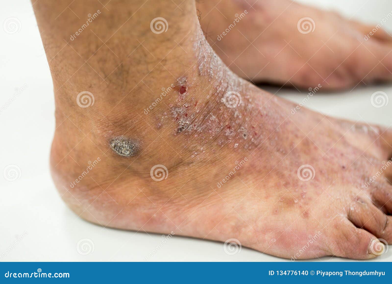 Atopic Dermatitis AD, Also Known As Atopic Eczema, is a Type of ...