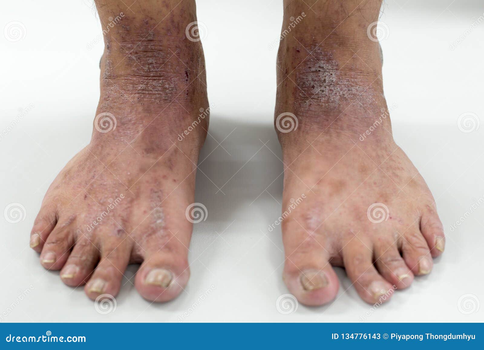 Atopic Dermatitis AD, Also Known As Atopic Eczema, is a Type of ...
