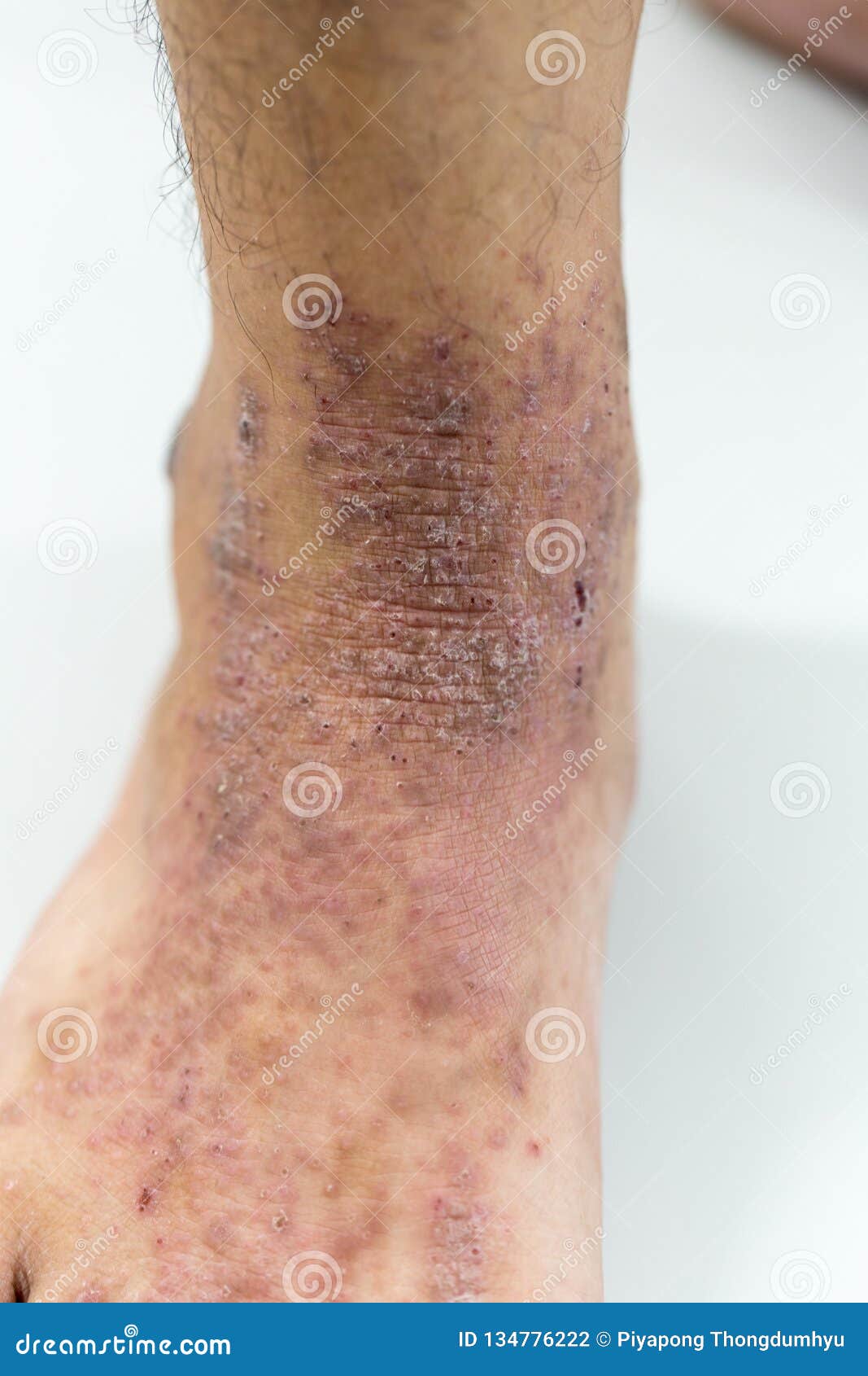 Atopic Dermatitis AD, Also Known As Atopic Eczema, is a Type of ...