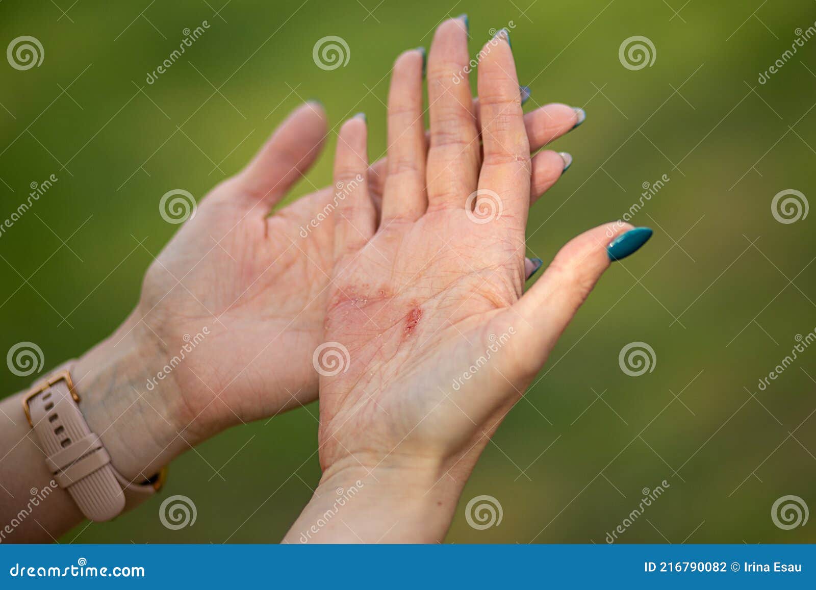 Atopic Dermatitis , Also Known As Atopic Eczema, is a Type of ...