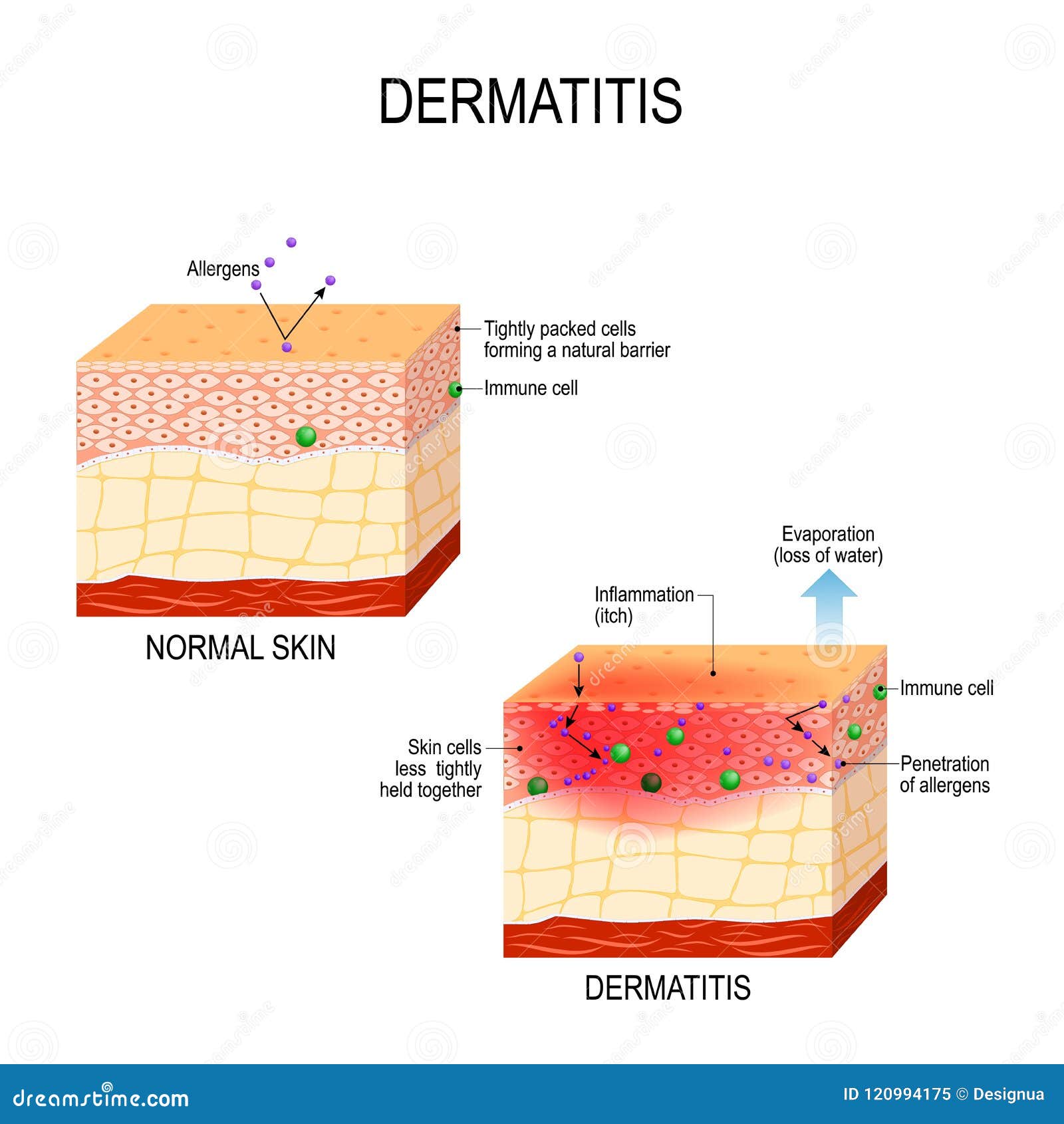 Atopic Dermatitis Eczema Stock Vector Illustration Of Illness 120994175